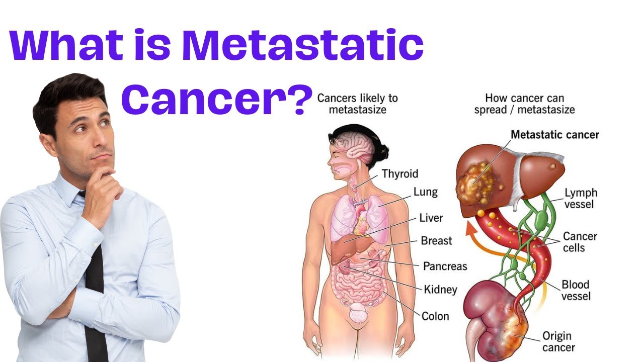 Understanding Metastasis | What is Metastatic Cancer? - YouTube