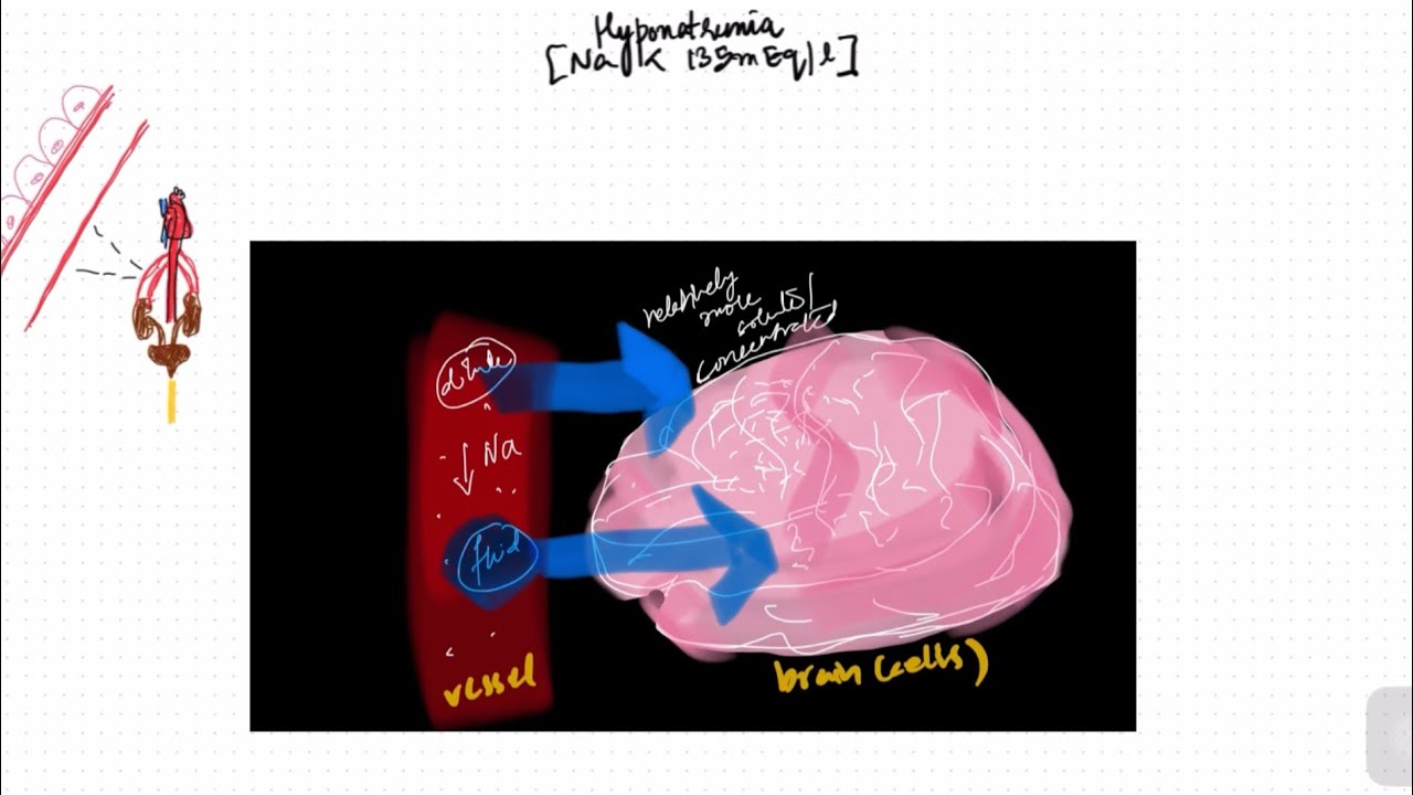 HYPONATREMIA for Med Students: Diagnostic Approach Algorithm made EASY ...