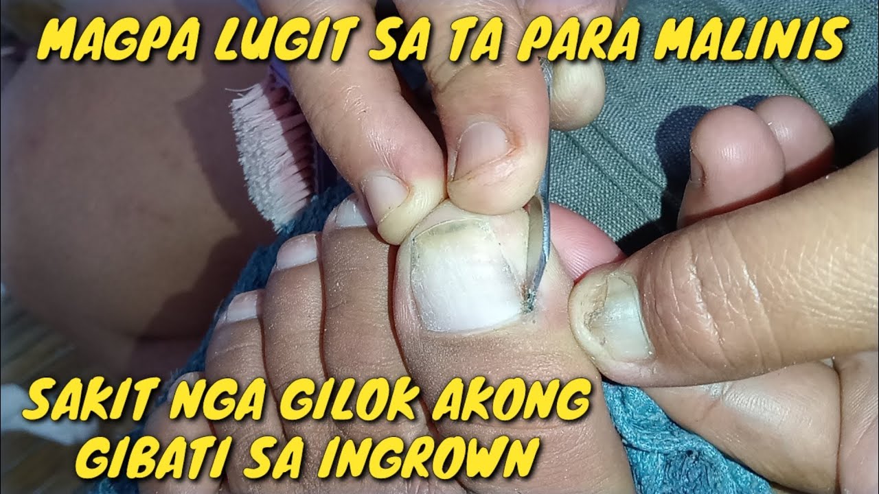 SARAP MAGPA LUGIT SA INGROWN PARA MAGANDA TINGNAN, #tashielipsvlog # ...