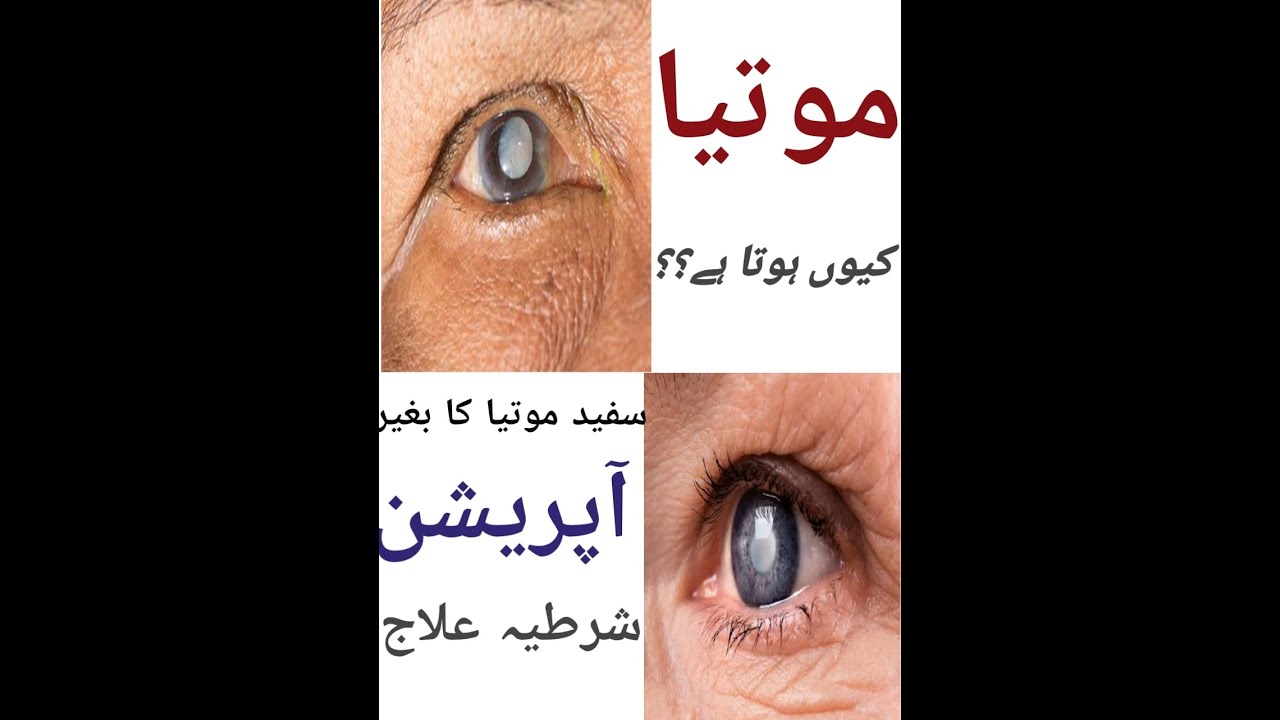 CATARACT | safaid motiya | ilaaj | HOMEOPATHIC MEDICINES - YouTube