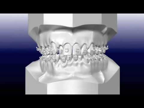 Beugel-Orthodontie - YouTube