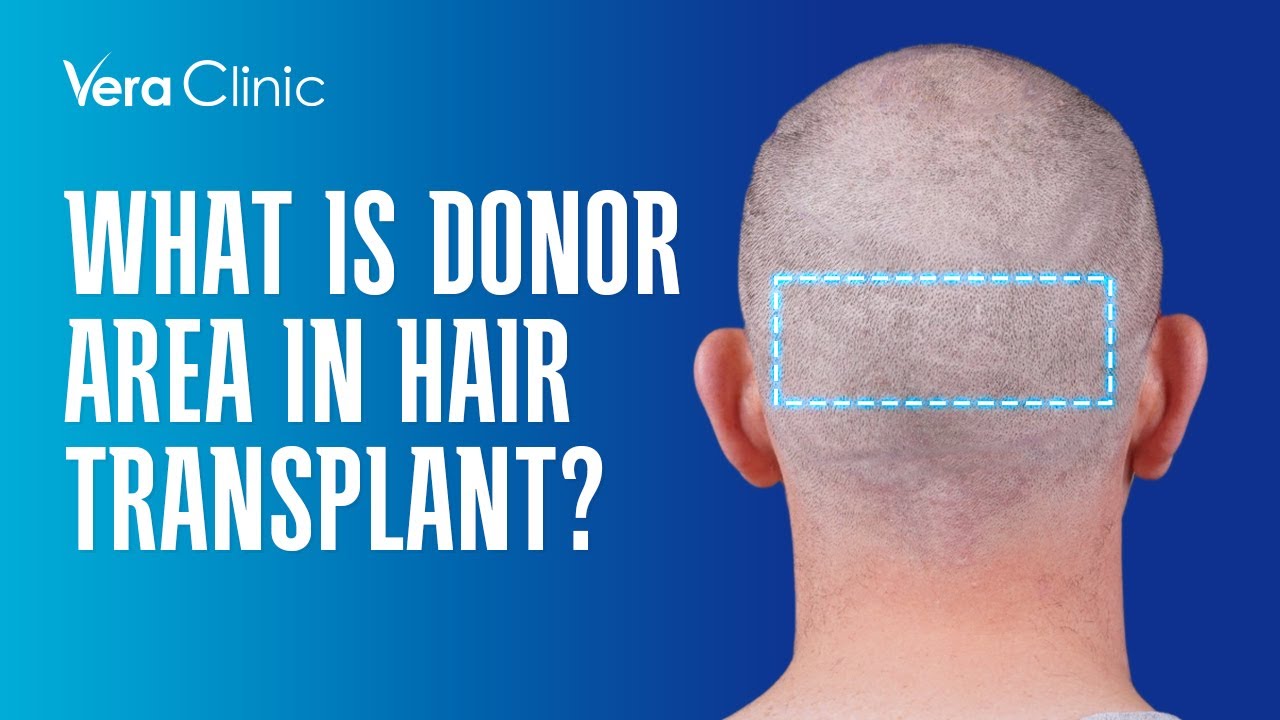 What is donor area in hair transplant? #hairtransplant # ...