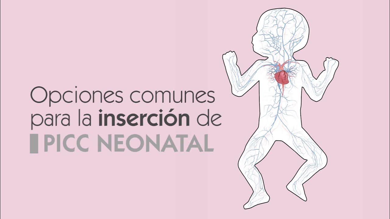 Posiciones comunes para la colocación del PICC en neonatos: vena cefálica - YouTube
