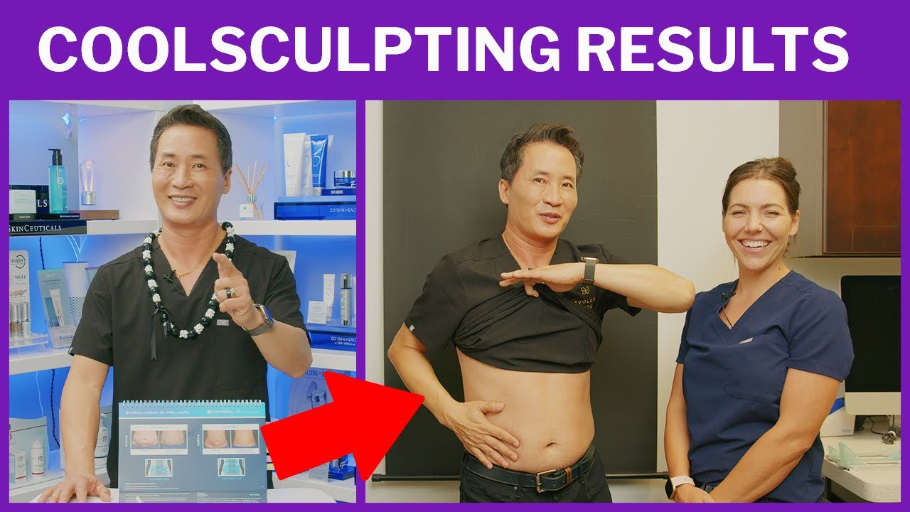 CoolSculpting: Left vs Right Experiment | Dr. David Yew - YouTube
