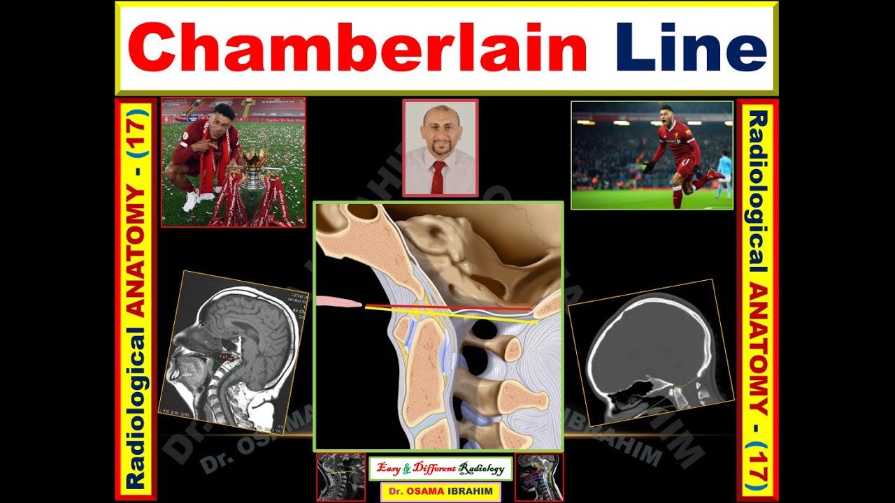 Chamberlain Line Radiological Anatomy (Episode-17); Basilar ...