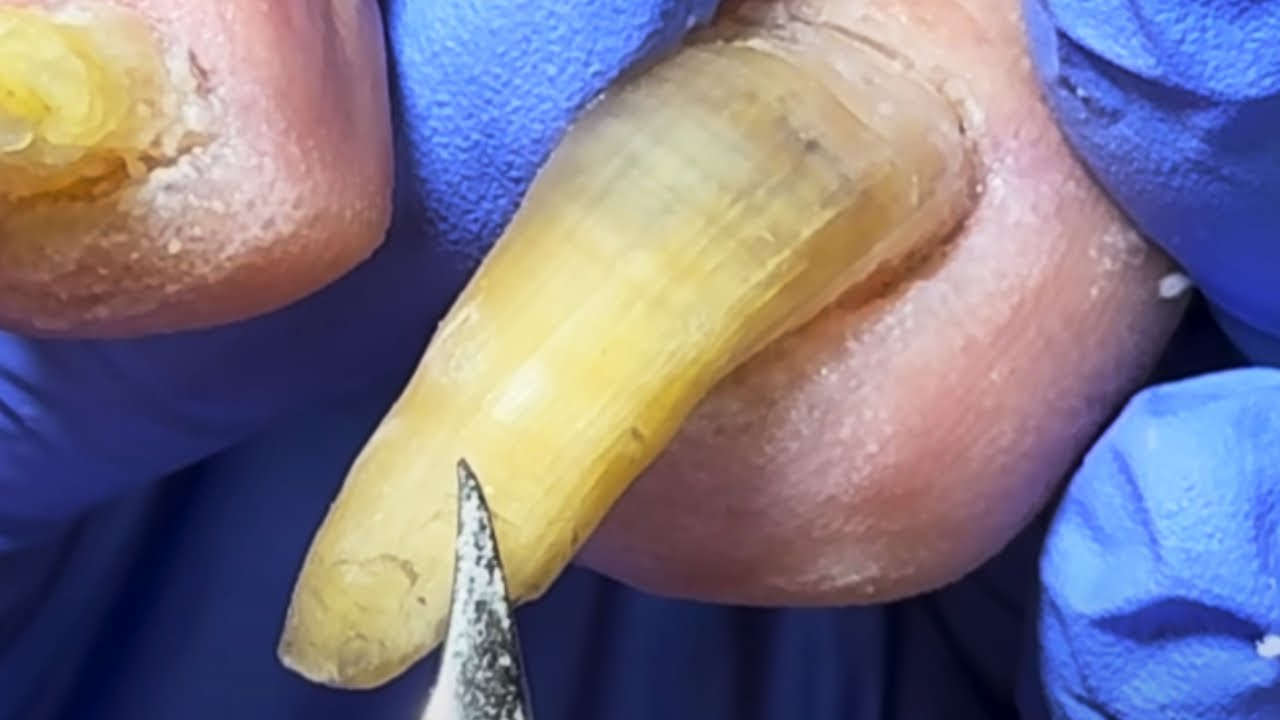Wow, These Toenails Are Too Long, Trim Them Carefully!【Podiatry Clinic ...
