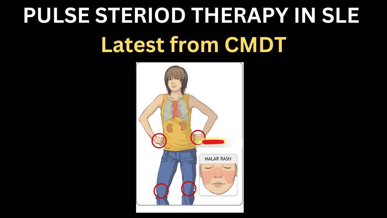 PULSE STERIOD THERAPY IN SLE | LATEST FROM CMDT - YouTube