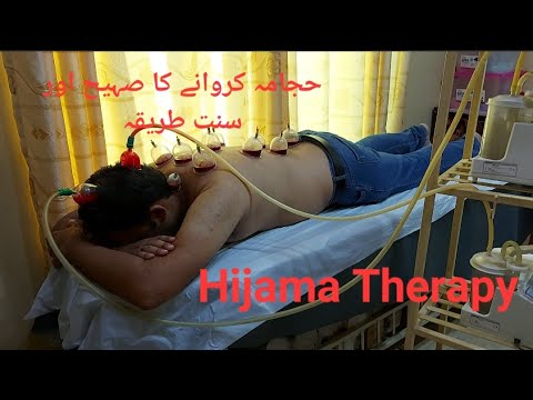 Hijama Cupping therapy from expert doctor on sunnah points on sunnah ...