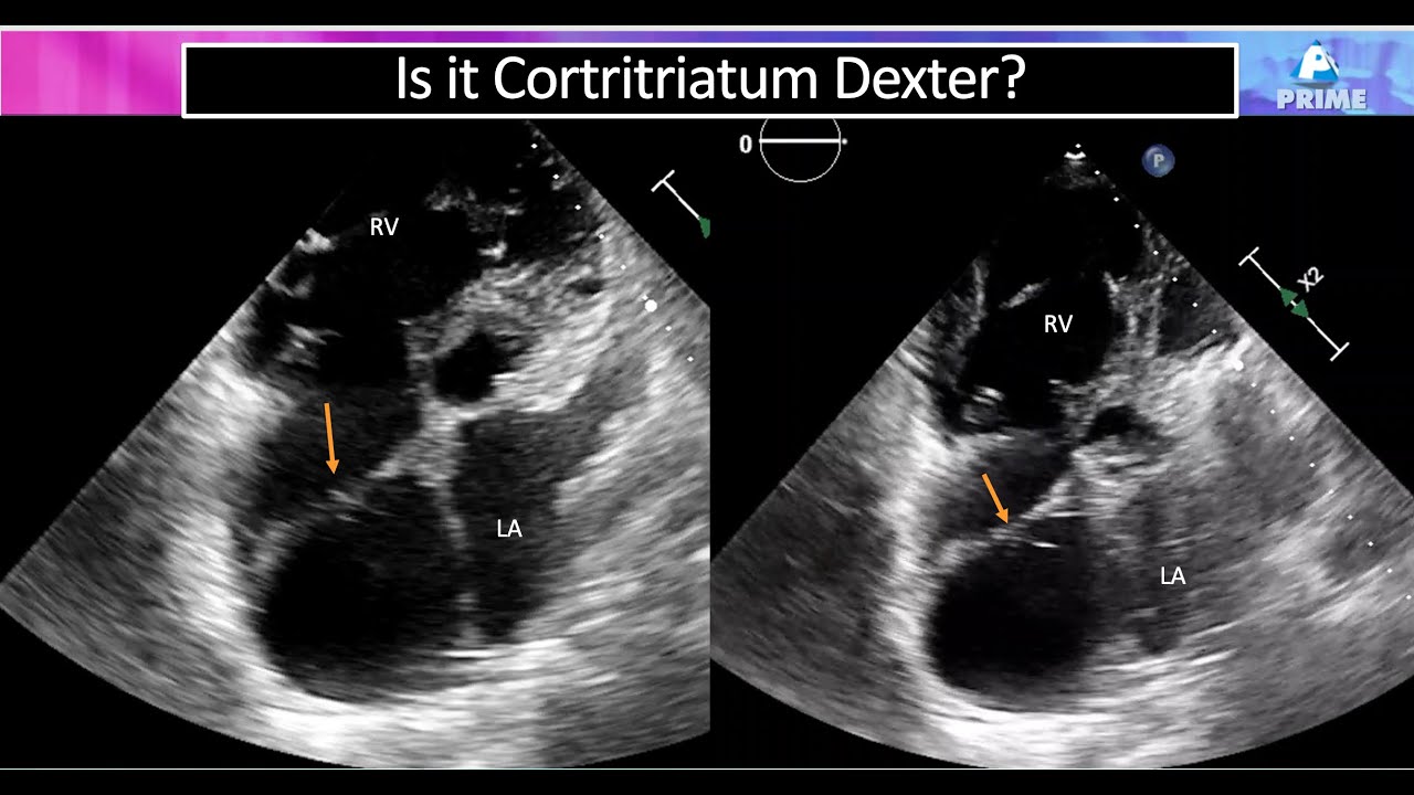 Cortriatriatum Dexter or normal Eustachian valve - YouTube