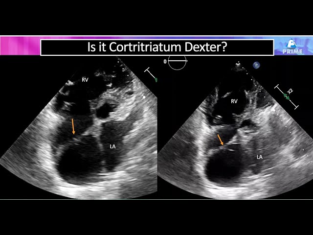 What Is Eustachian Valve