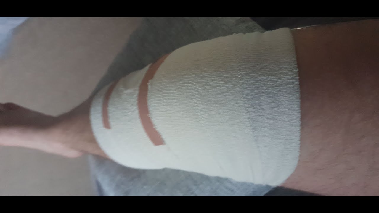 ACL Injury - Pre/Post Op - YouTube