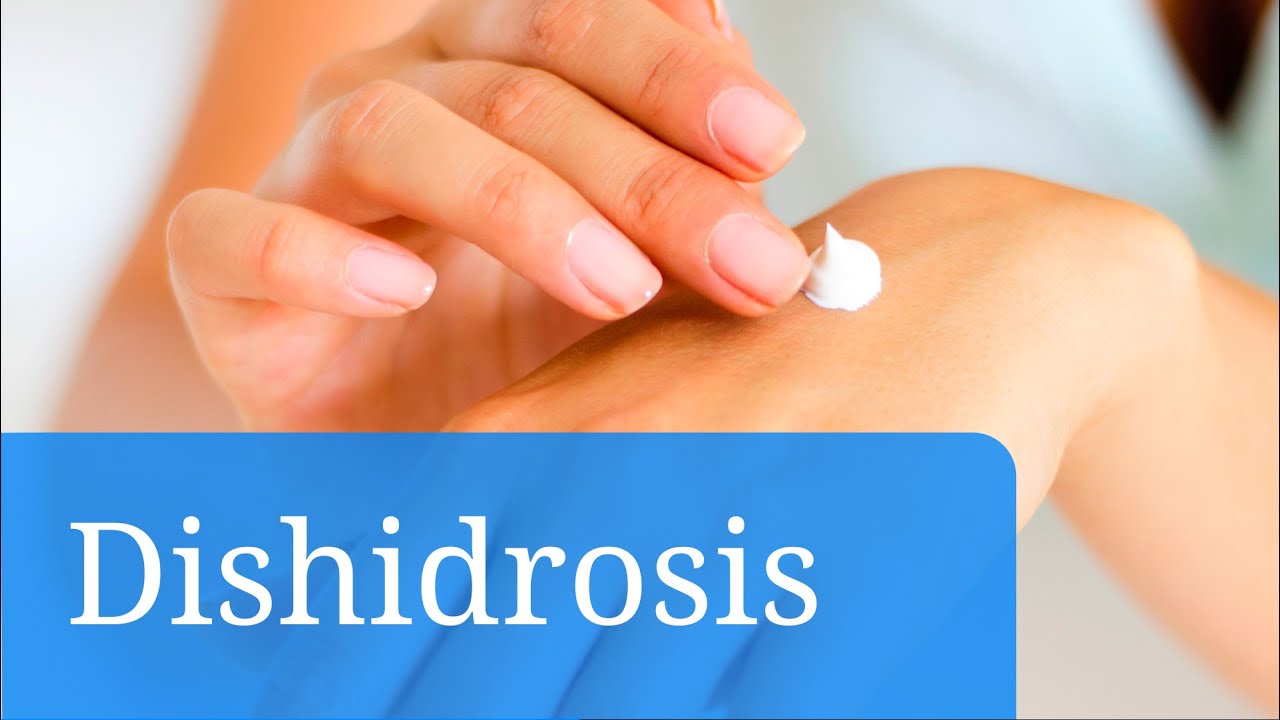 Dishidrosis: qué es, fotos, tratamientos y posibles curas - YouTube