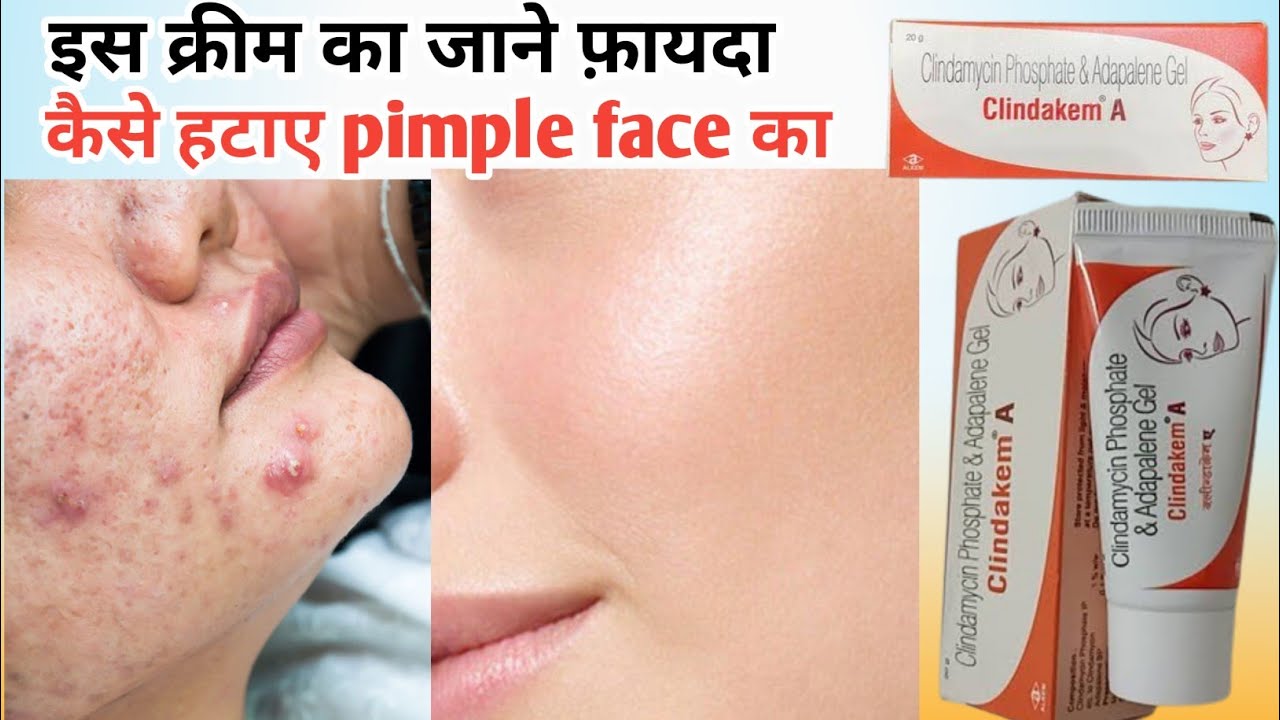 Clindakem A Cream Gel review कील मुंहासे की दाग हटाने का बहुत बेस्ट ...