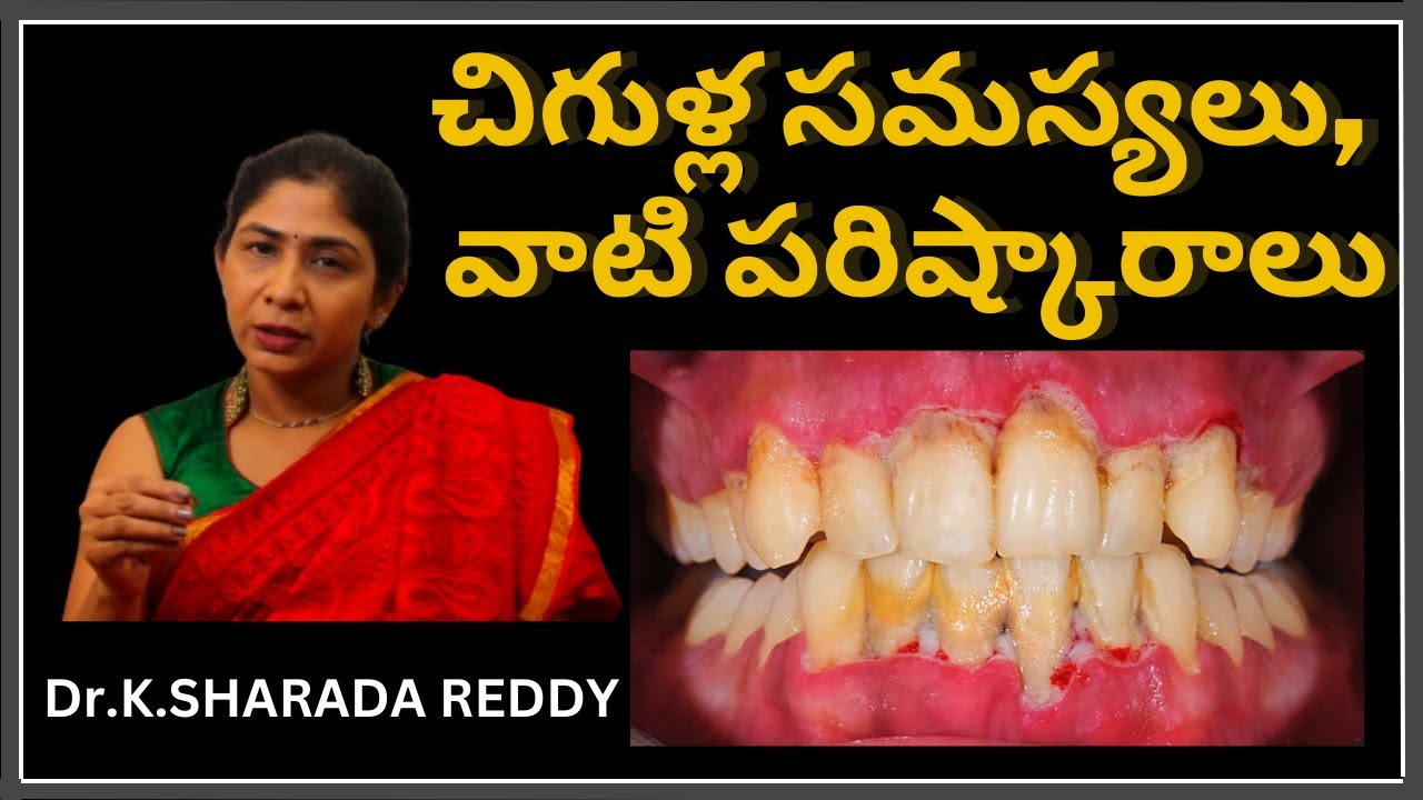 చిగుళ్ల సమస్యలు | వాటి పరిష్కారాలు | GUM PROBLEMS | DR.SHARADA REDDY # ...