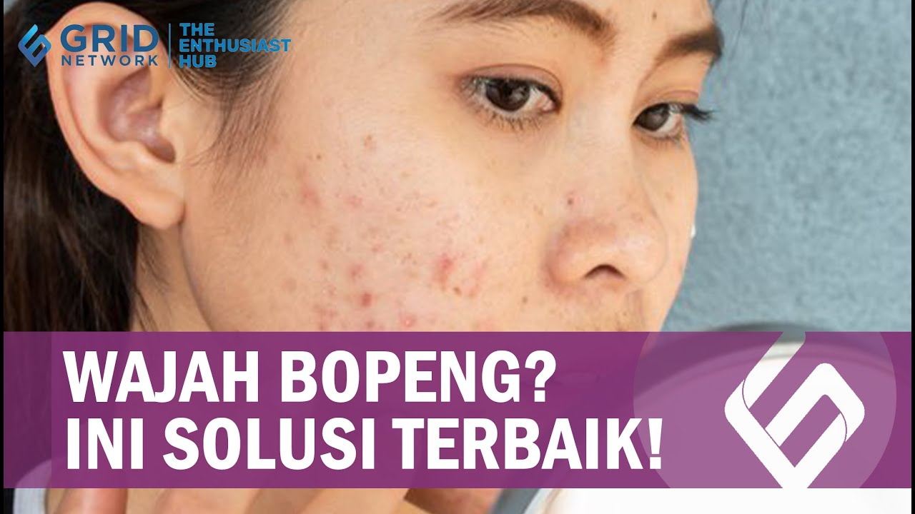 Pakai skincare tidak ampuh atasi bopeng lakukan cara ini! - YouTube