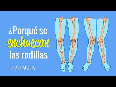 ¿Porqué se enchuecan las rodillas? Genu varo - Genu valgo