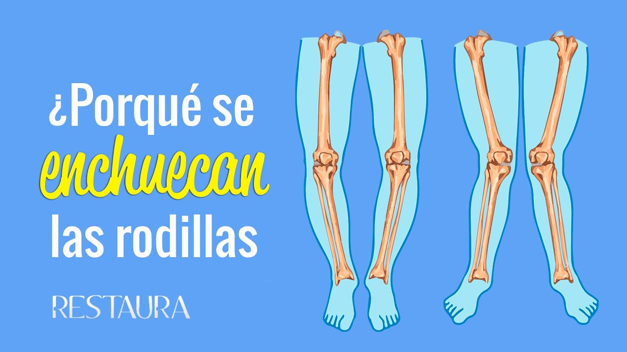 ¿Porqué se enchuecan las rodillas? Genu varo - Genu valgo - YouTube