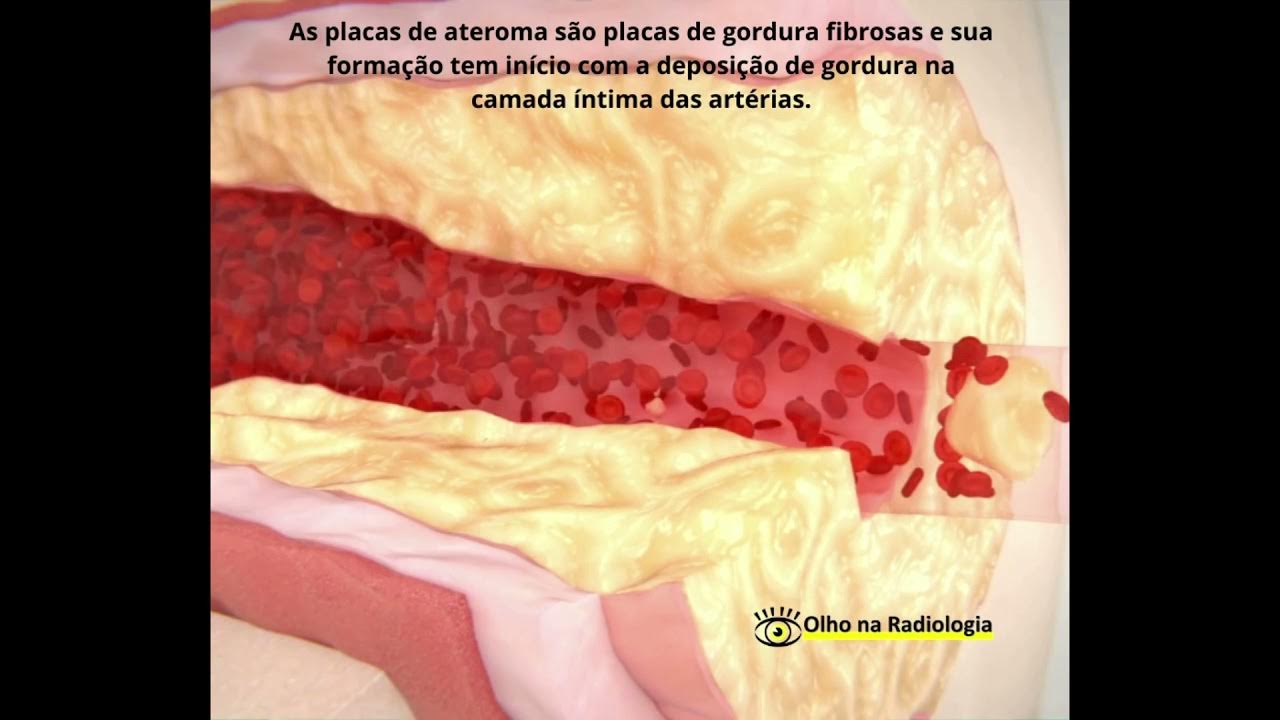 Formação Da Placa De Ateroma - RETOEDU