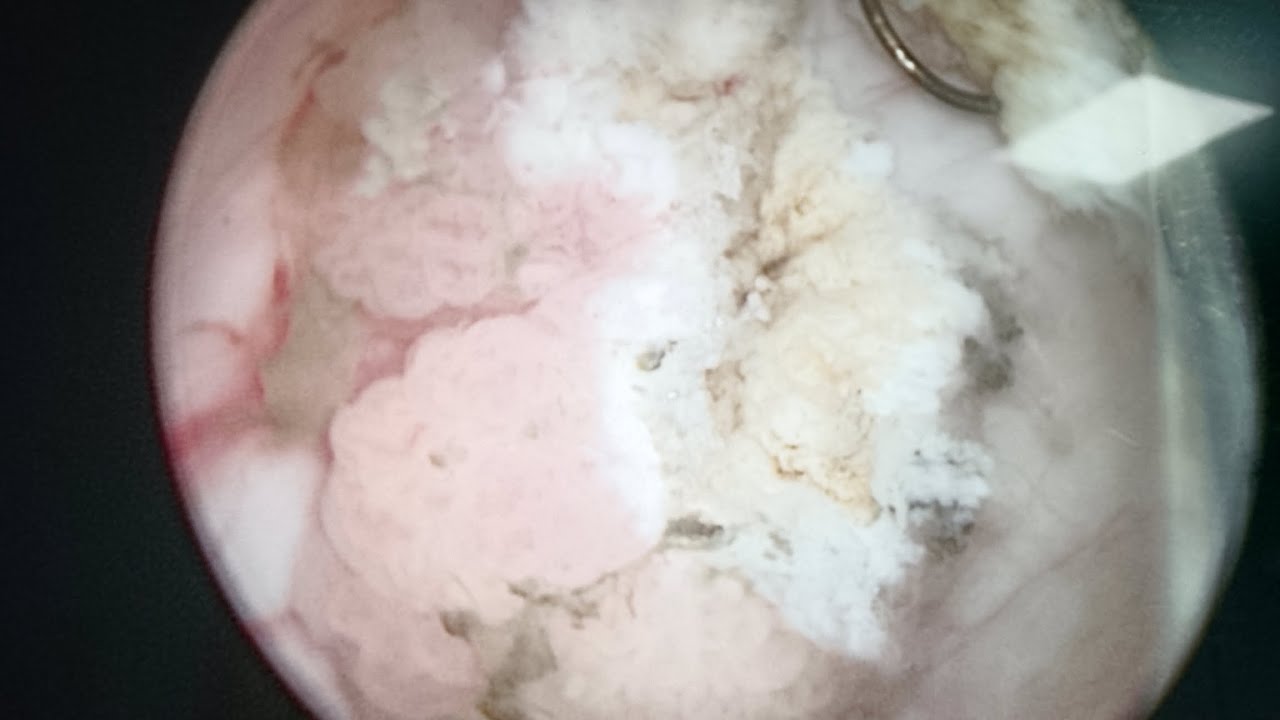 Surgery (TURBT) of Tumour in a Urinary Bladder Diverticula (A technical ...