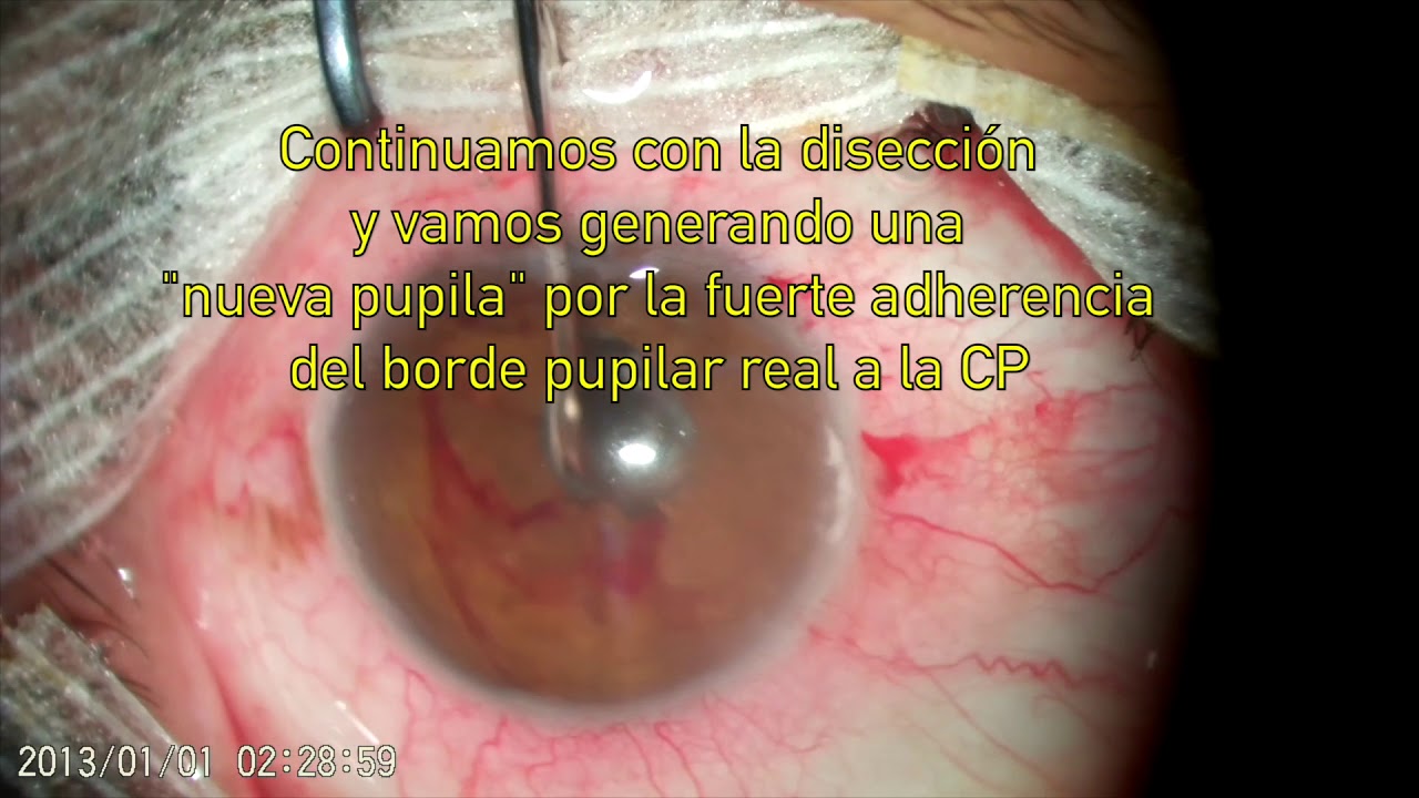 IOL EXCHANGE. Dislocated PMMA IOL x 3-Piece PCIOL - YouTube