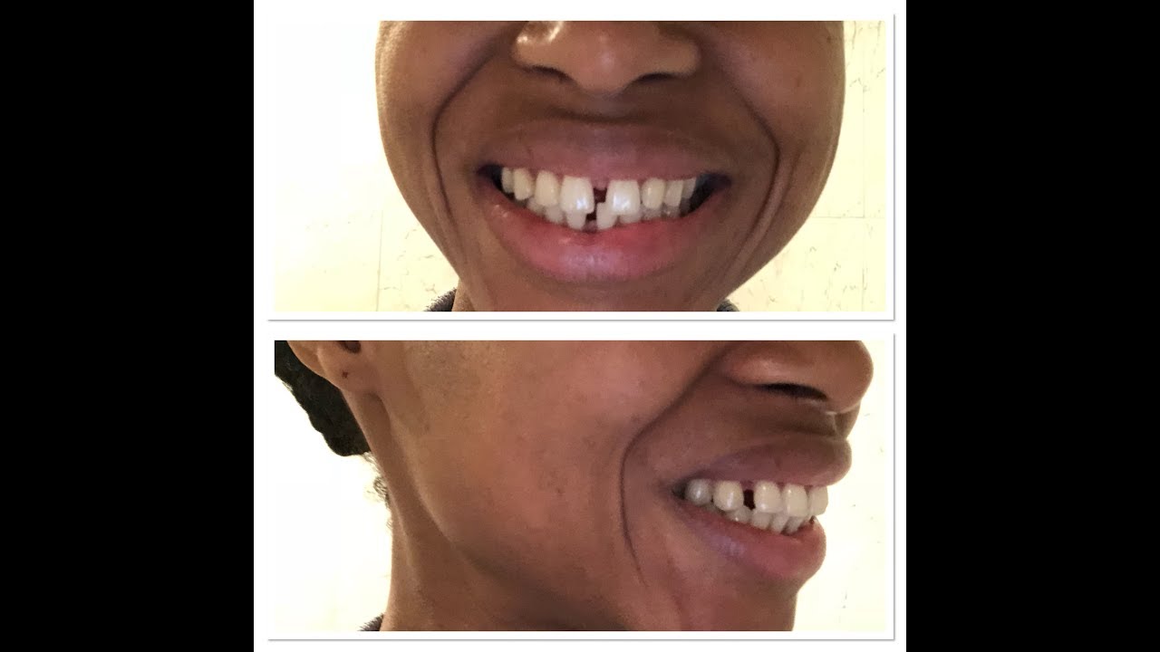 Invisalign For Gaps My First Aligners YouTube invisalign-for-gaps-my-first-aligners-youtube