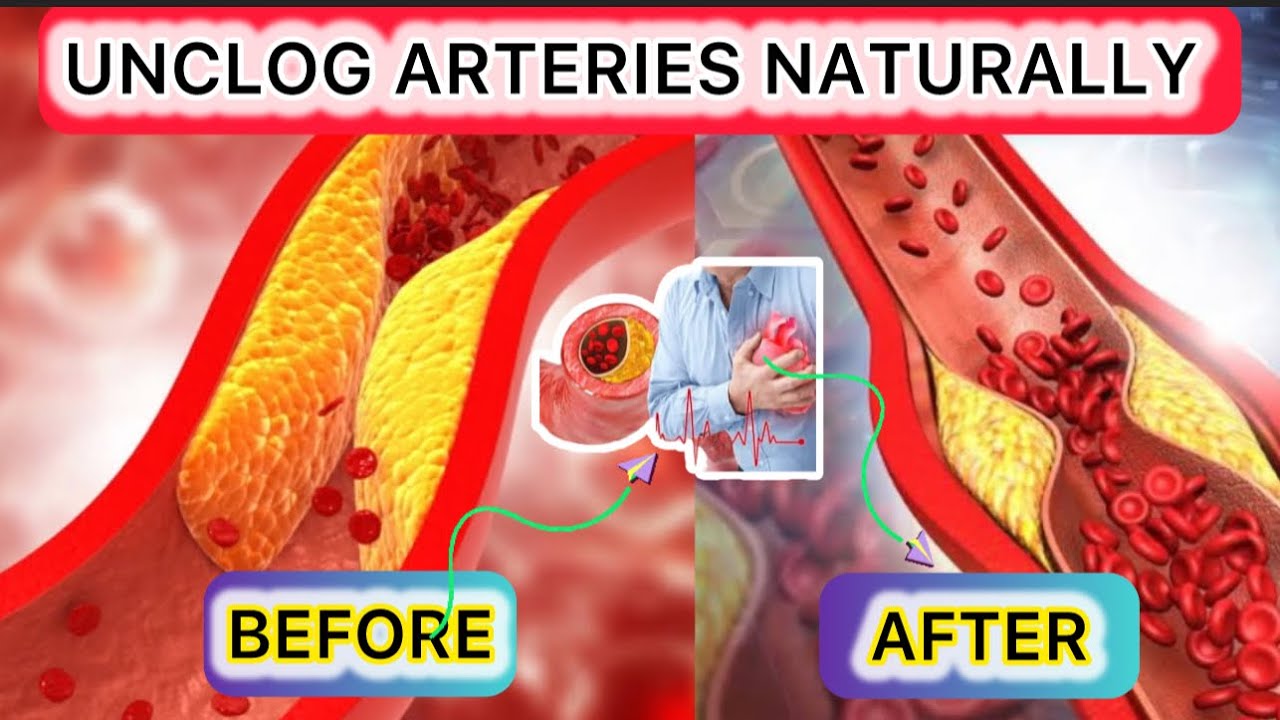 10 Best Food To Unclog Arteries How To Unclog Your Arteries And