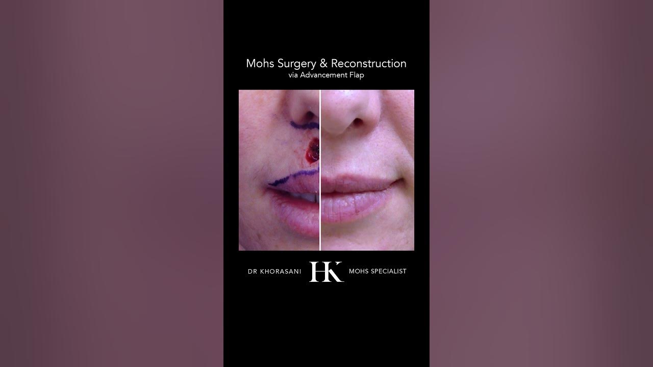 Scar Revision On Lip After Mohs Surgery Using Advancement Flap Closure Dr Hooman Khorasani