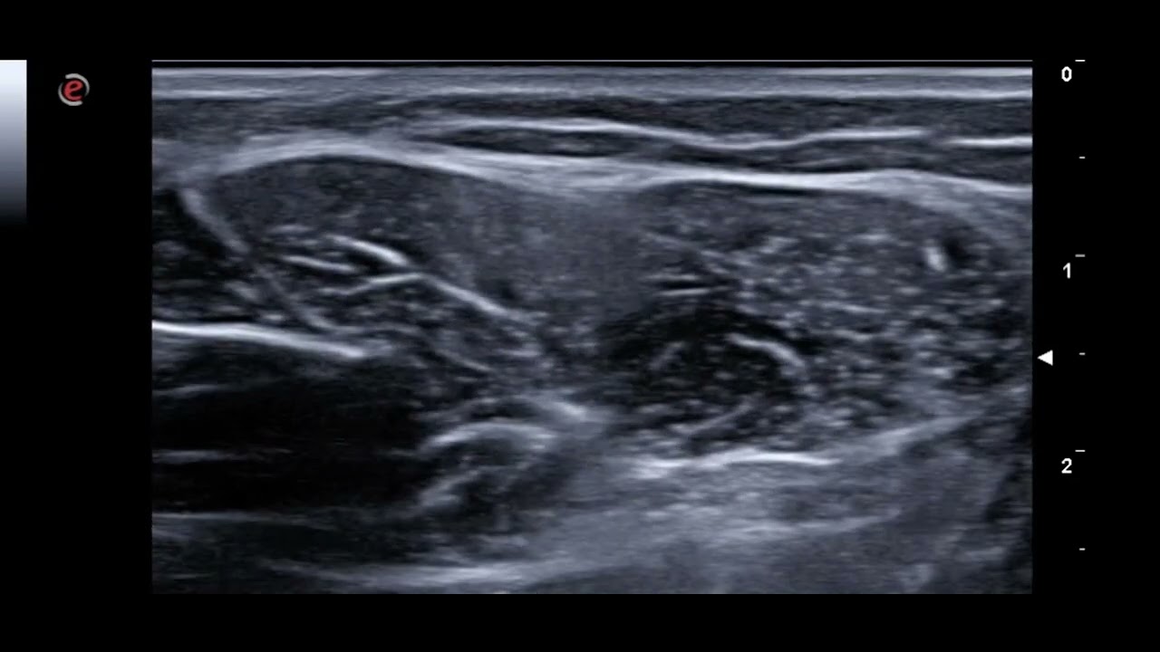 Cryoneurolysis of hamstrings in a 6 year old for knee flexion ...