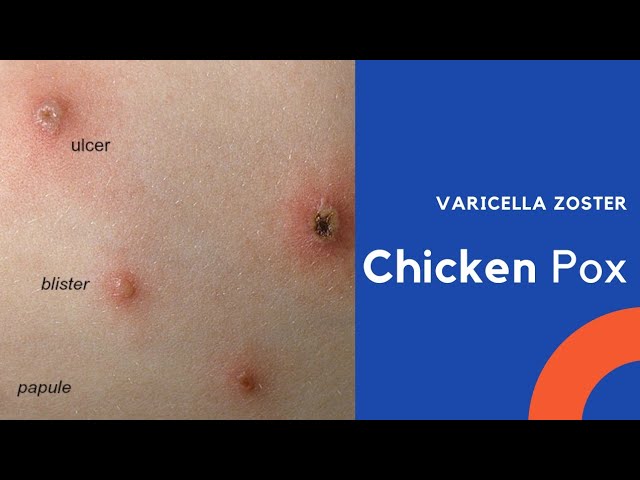 Chicken Pox Papule