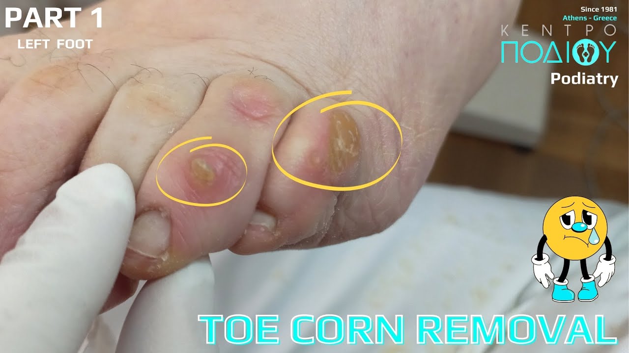 TOE CALLUS REMOVAL|Αφαίρεση επιδακτυλίων κάλων|Κέντρο Ποδιού Podiatry ...