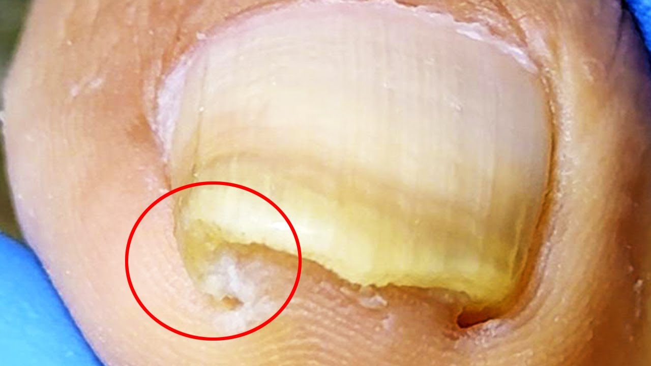 Curly Ingrown Toenails Are Buttoned Inwards And Trimmed【Xue Yidao ...