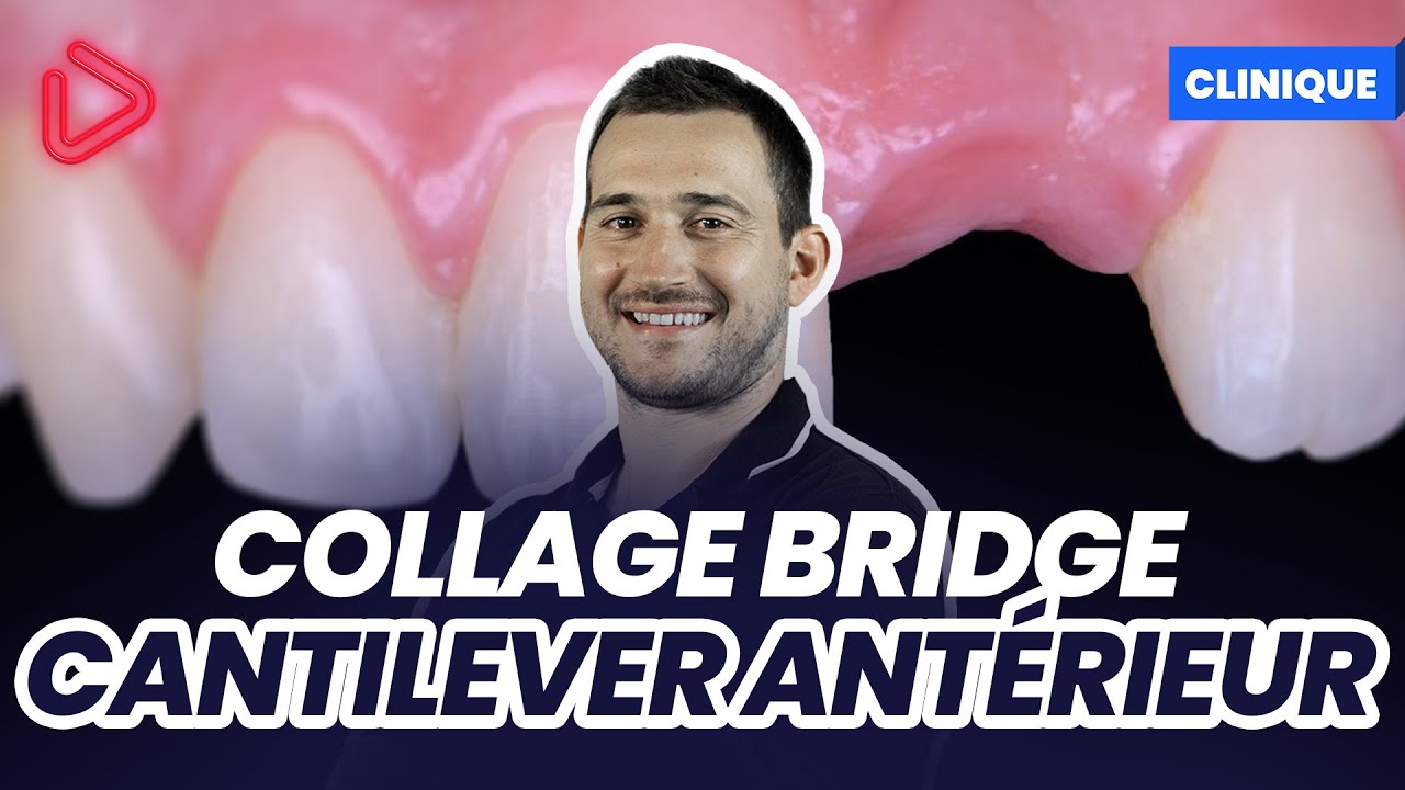 COLLAGE DE BRIDGE CANTILEVER EN REMPLACEMENT D'UNE INCISIVE CENTRALE ...