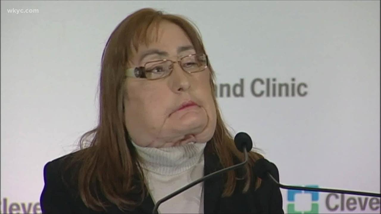 Doctors salute the life of Connie Culp, recipient of the first US face ...