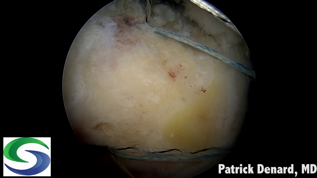 SCR combined with a rotator cuff repair - YouTube