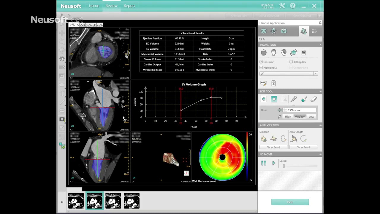 Use CFA Coronary By CT Scanner 128sl NeuViz - YouTube