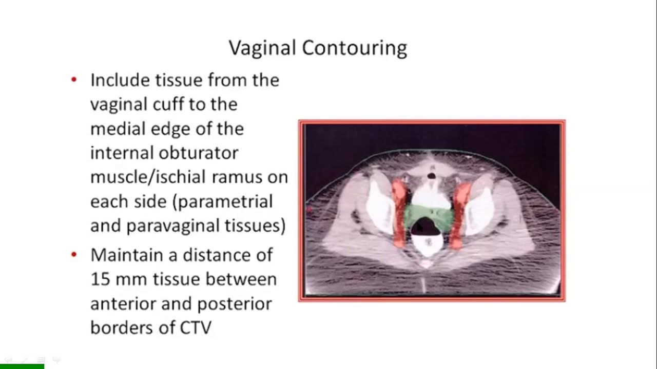 Contouring primary and pelvic nodal volumes for radiotherapy of ...