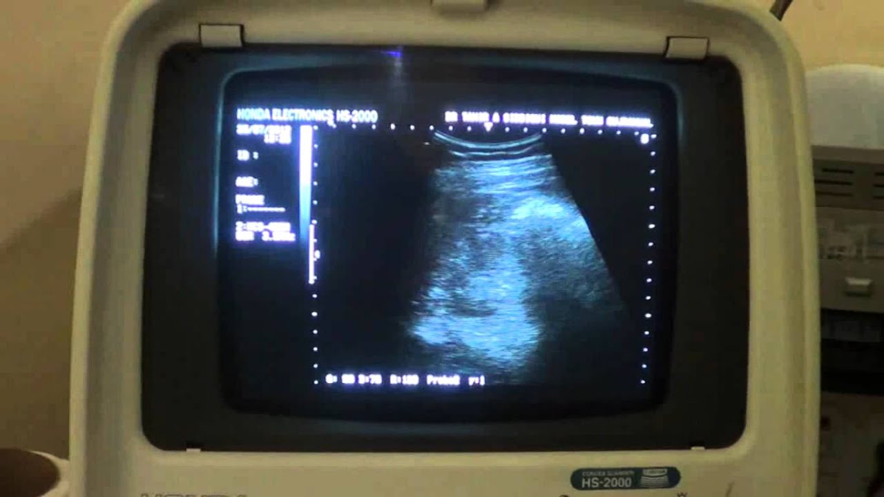 fetal lobulations IN ADULT LT KIDNEY - YouTube