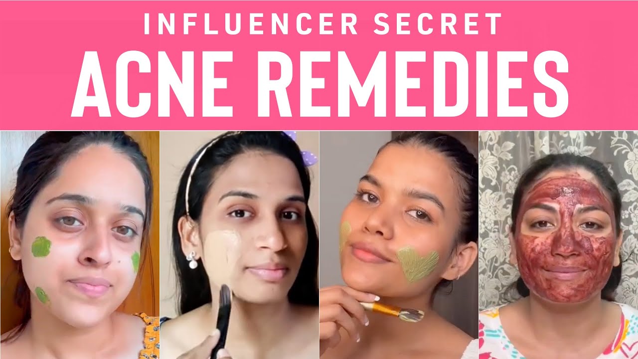 Acne Remedies That Actually Work From Our Favourite Influencers! - YouTube