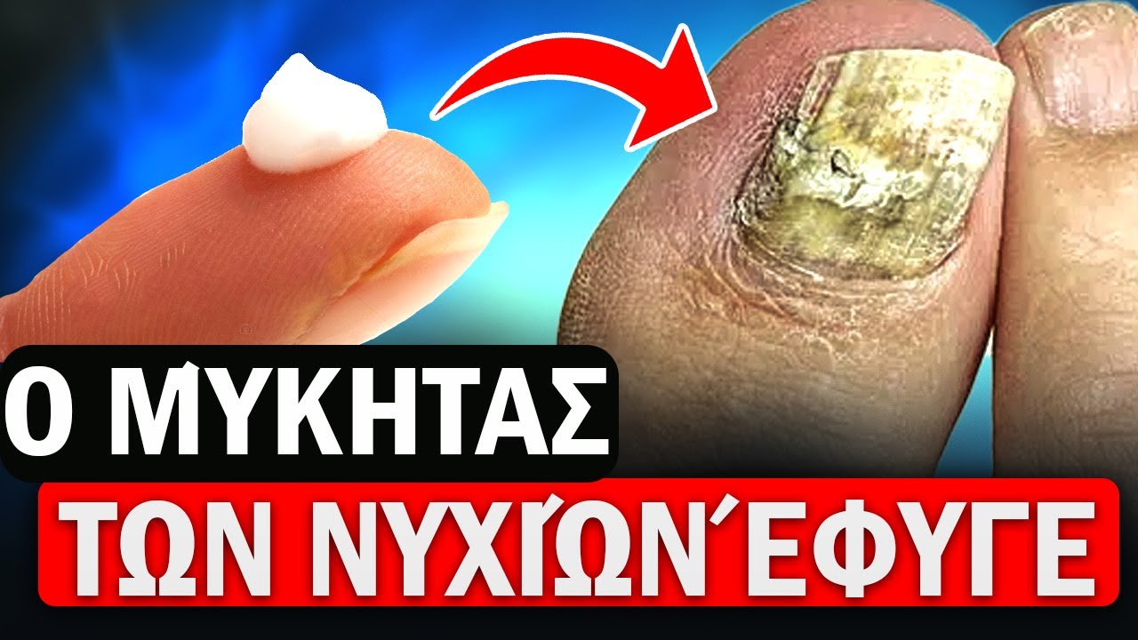Θυμηθείτε 1 λαϊκό τρόπο πώς να απαλλαγείτε από τον μύκητα των νυχιών ...