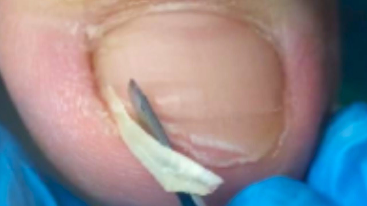 Very Short Toenails, Trim Long Ingrown Toenails - YouTube