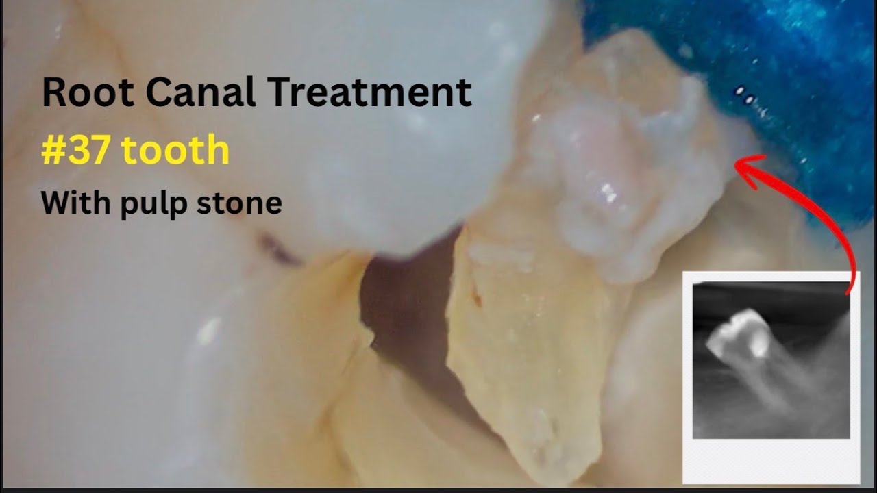 Full case of tilted molar with pulp stone - YouTube