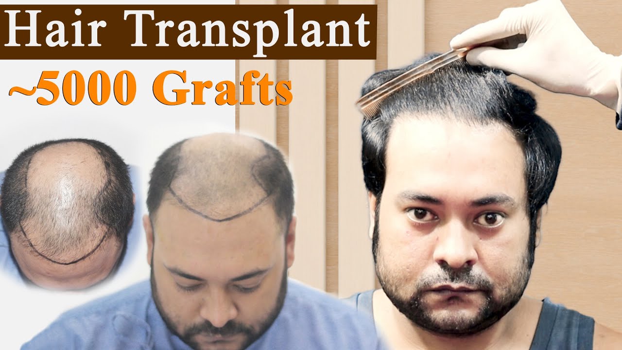 Hair Transplant In India Results Natural Hairline Grade 7 Dr Suneet