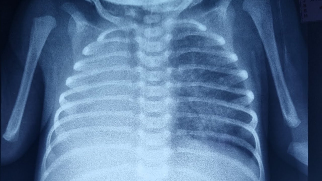 Diagnostic bronchoscopy in a newborn baby - YouTube