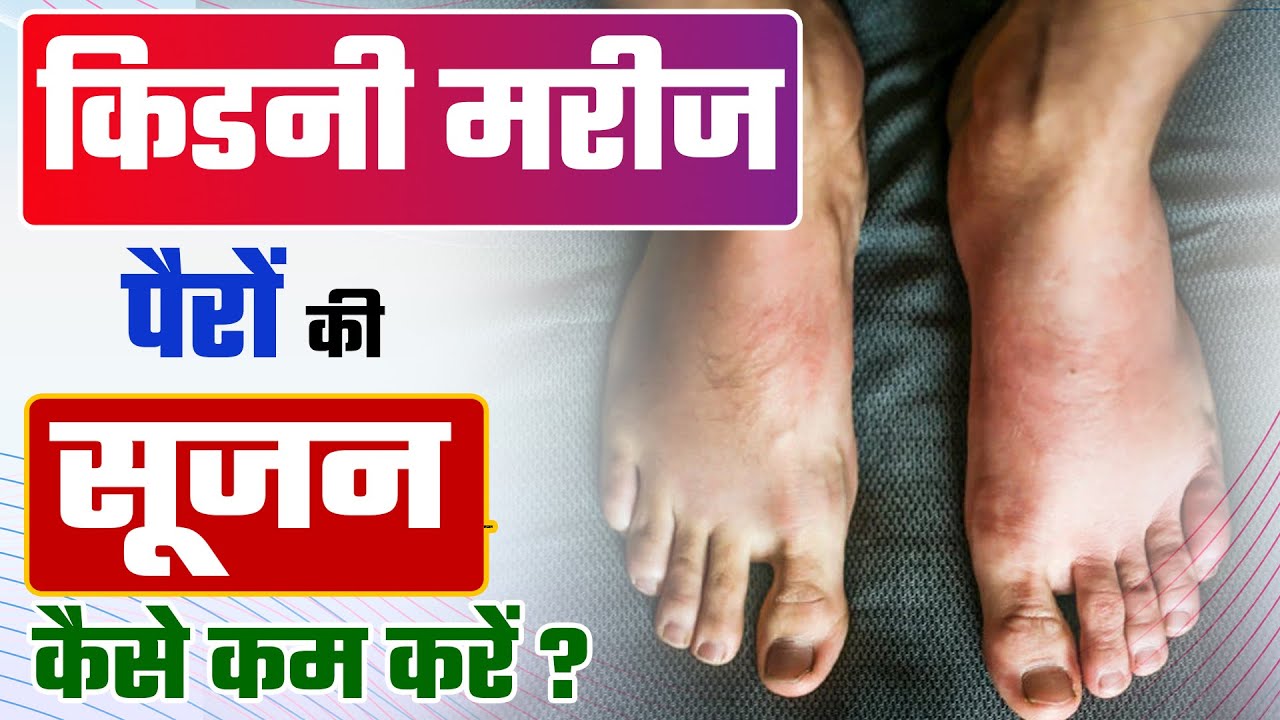 किडनी मरीज पैरों की सूजन कैसे कम करें | Treatment of Leg Swelling in ...