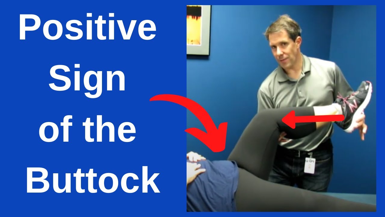 Positive Sign of the Buttock Test - YouTube