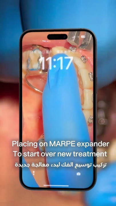 #marpe #bracestreatment #orthodontist - YouTube