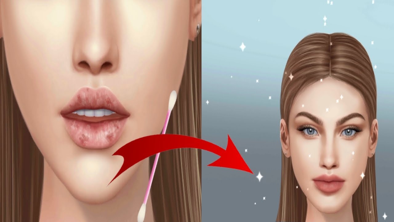 ASMR Mukbang acne extract around mouth corner | Pimple popping ...
