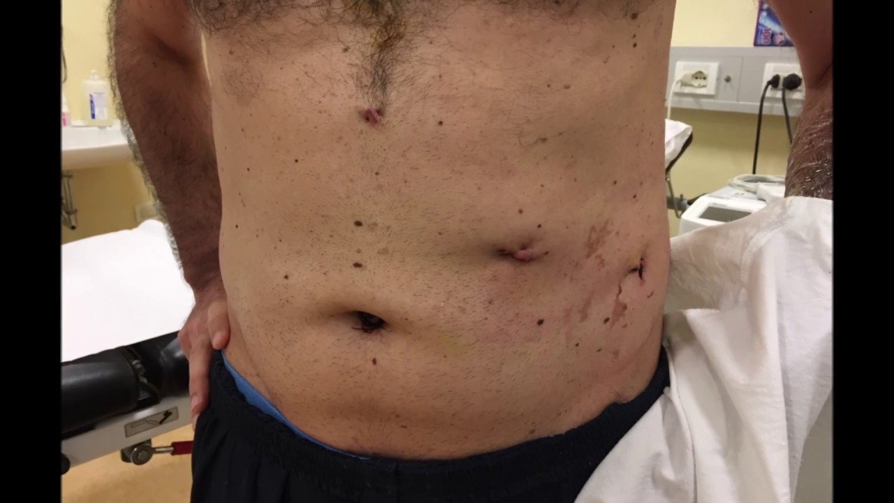 Laparoscopic splenectomy after splenic artery embolization failure for ...