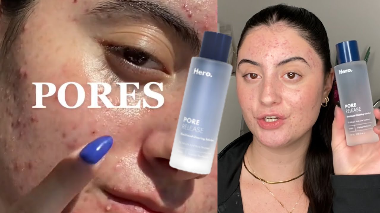 HERO PORE RELEASE 2% SALICYLIC ACID SOLUTION ON ACNE & BLACKHEADS - YouTube