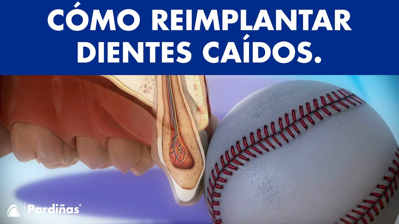 Avulsión dental - Cómo reimplantar un diente caído por accidente ...